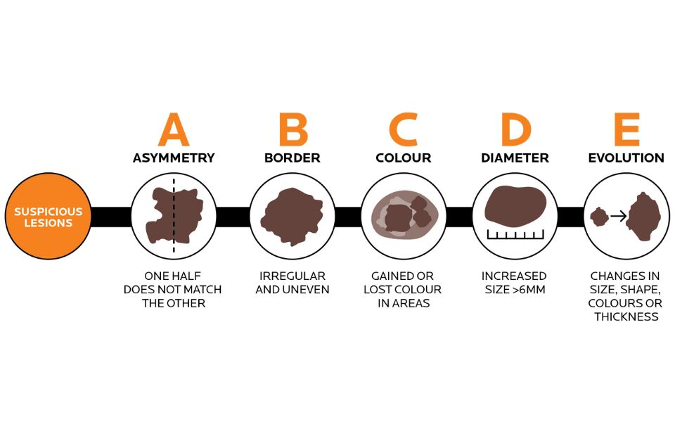 How to Conduct a Skin Mole Check | La Roche-Posay Australia