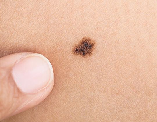 different types moles